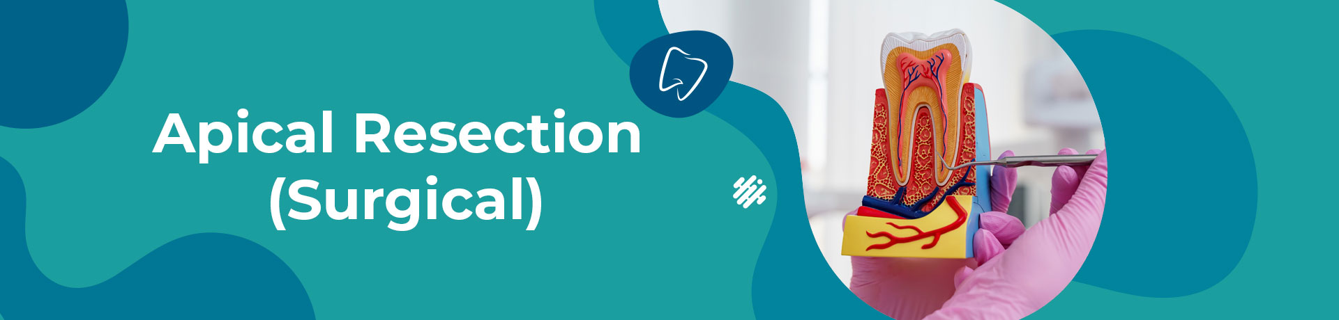 Apical Resection Surgery in Istanbul | What is The Procedure