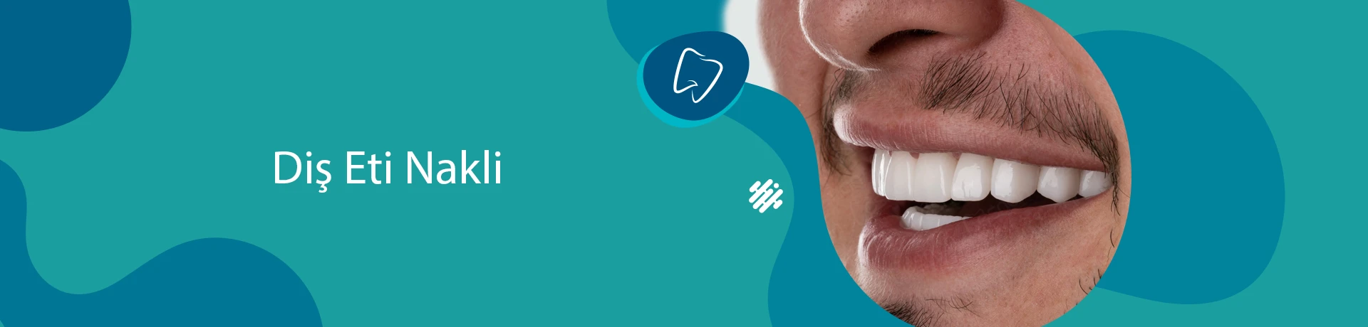 Esnan Dental Clinics | Diş Eti Nakli