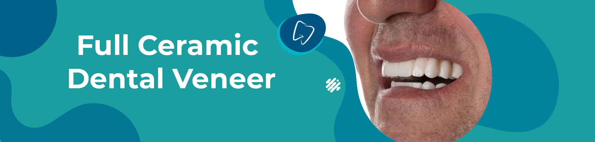 Full Ceramic Dental Veneer | Dental Aeshtetic in Turkey