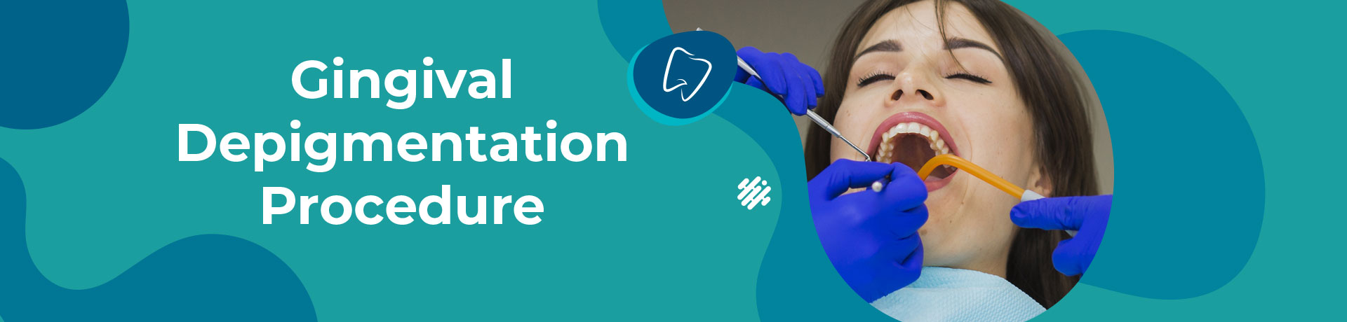 Esnan Dental Clinics | Gingival Depigmentation Procedure