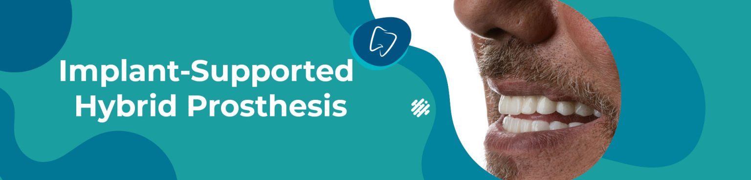 Esnan Dental Clinics | Implant-Supported Hybrid Prosthesis