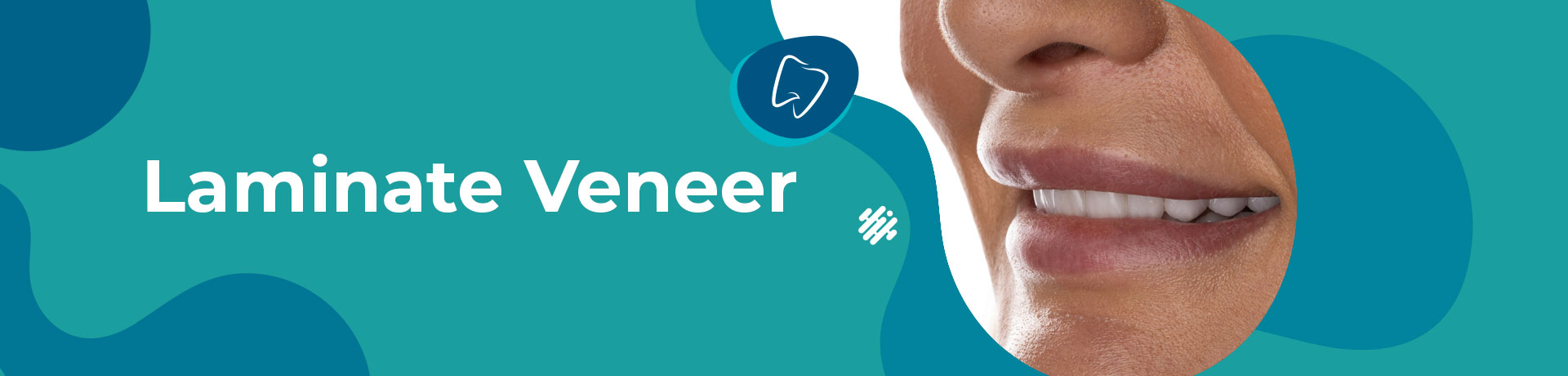 Laminate Veneers in Turkey | What is The Procedure