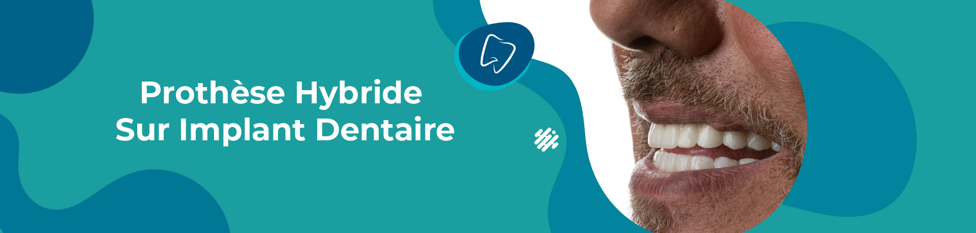 Esnan Dental Clinics | Prothèse Hybride Sur Implant Dentaire