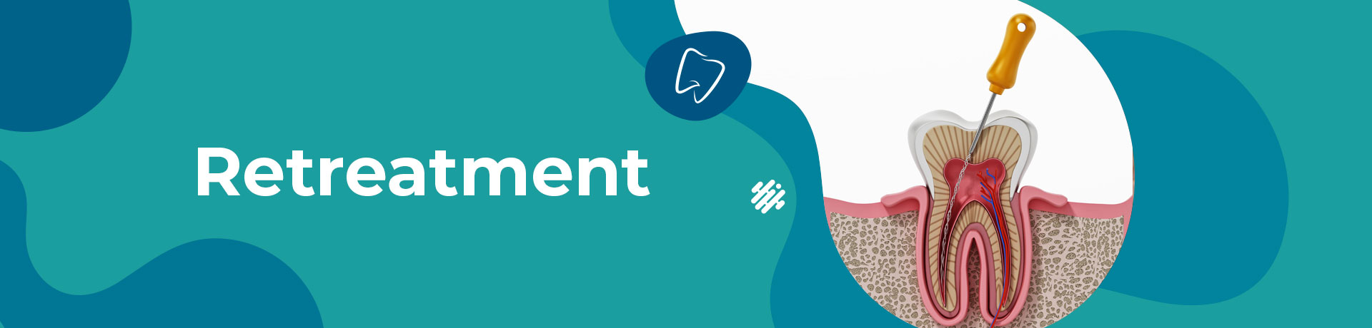 Root Canal Retreatment in Istanbul | Finding an Endodontist