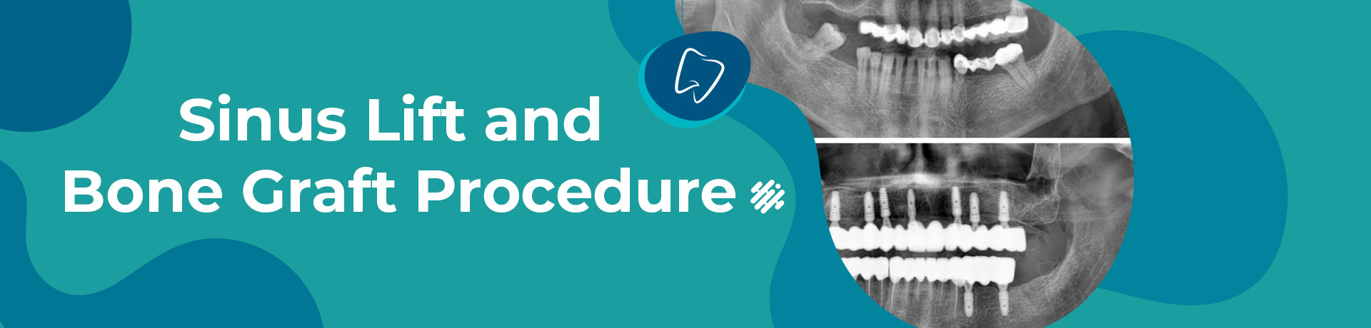 Bone Graft Procedure and Sinus Lifting Surgery in Turkey