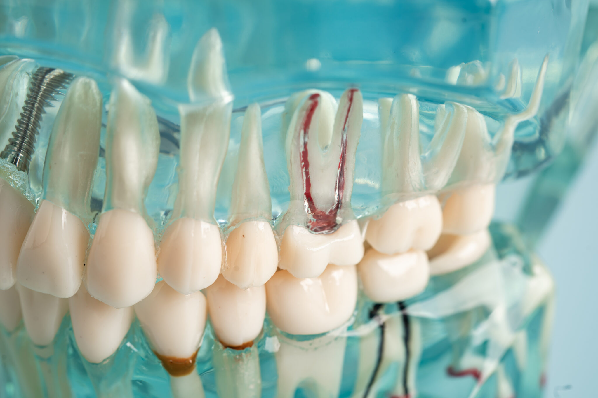 #1 Endodontics Root Canal Treatment in Turkey | Affordable & Trusted ...