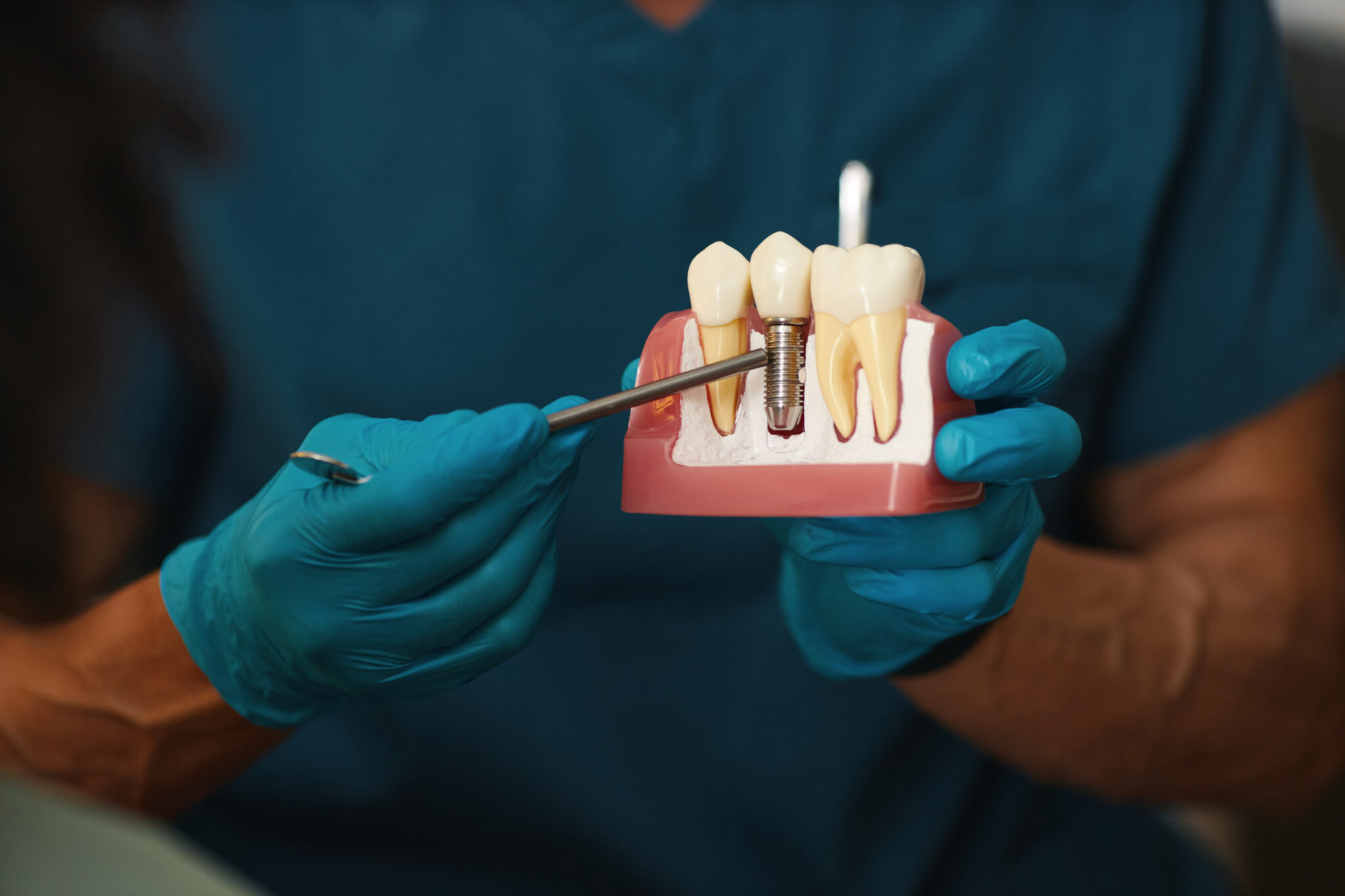 #1 Endodontics Root Canal Treatment in Turkey | Affordable & Trusted ...