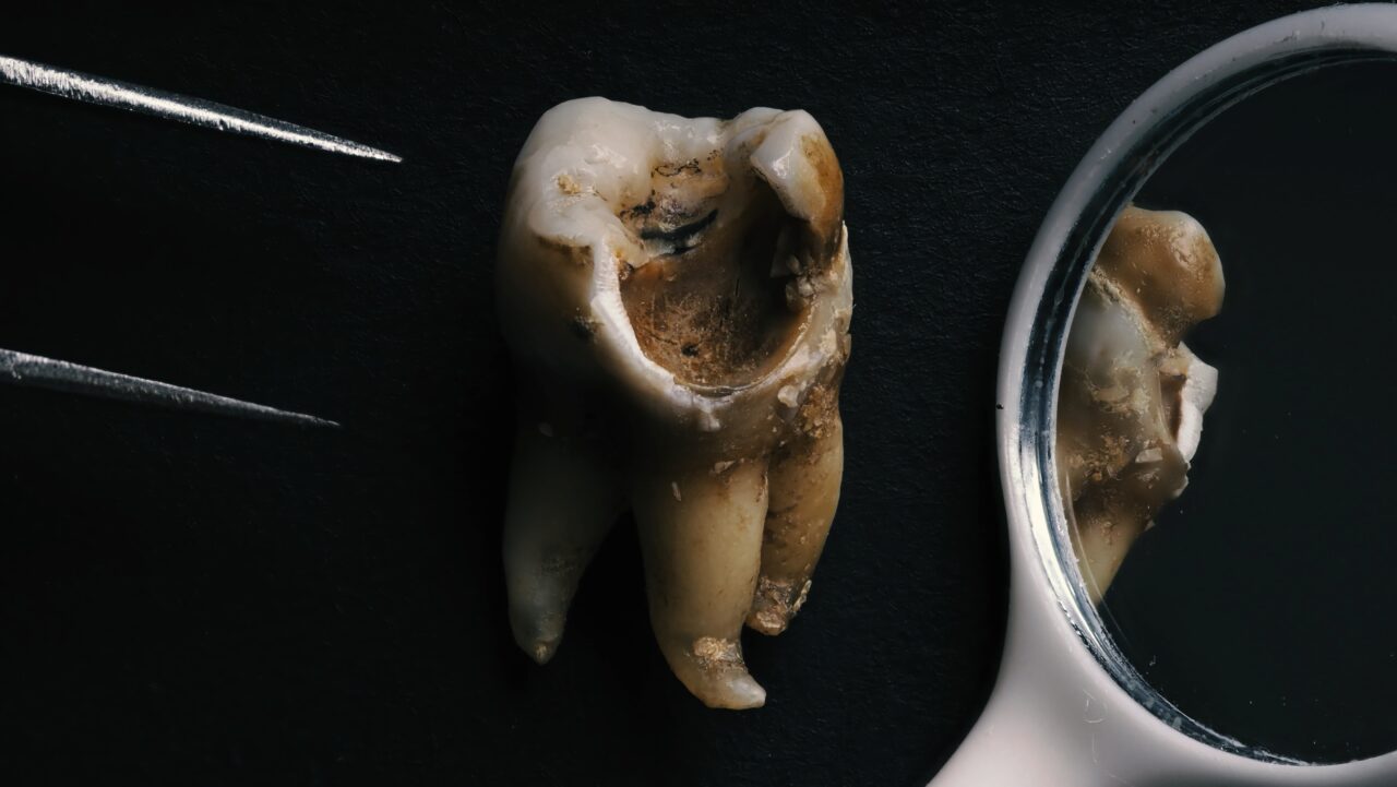 Tooth Infection Treatment: Causes, Treatment Methods, and Dental Care ...